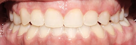 Braces Treatment Options For Fixing Underbite in Adults, Adult Orthodontics