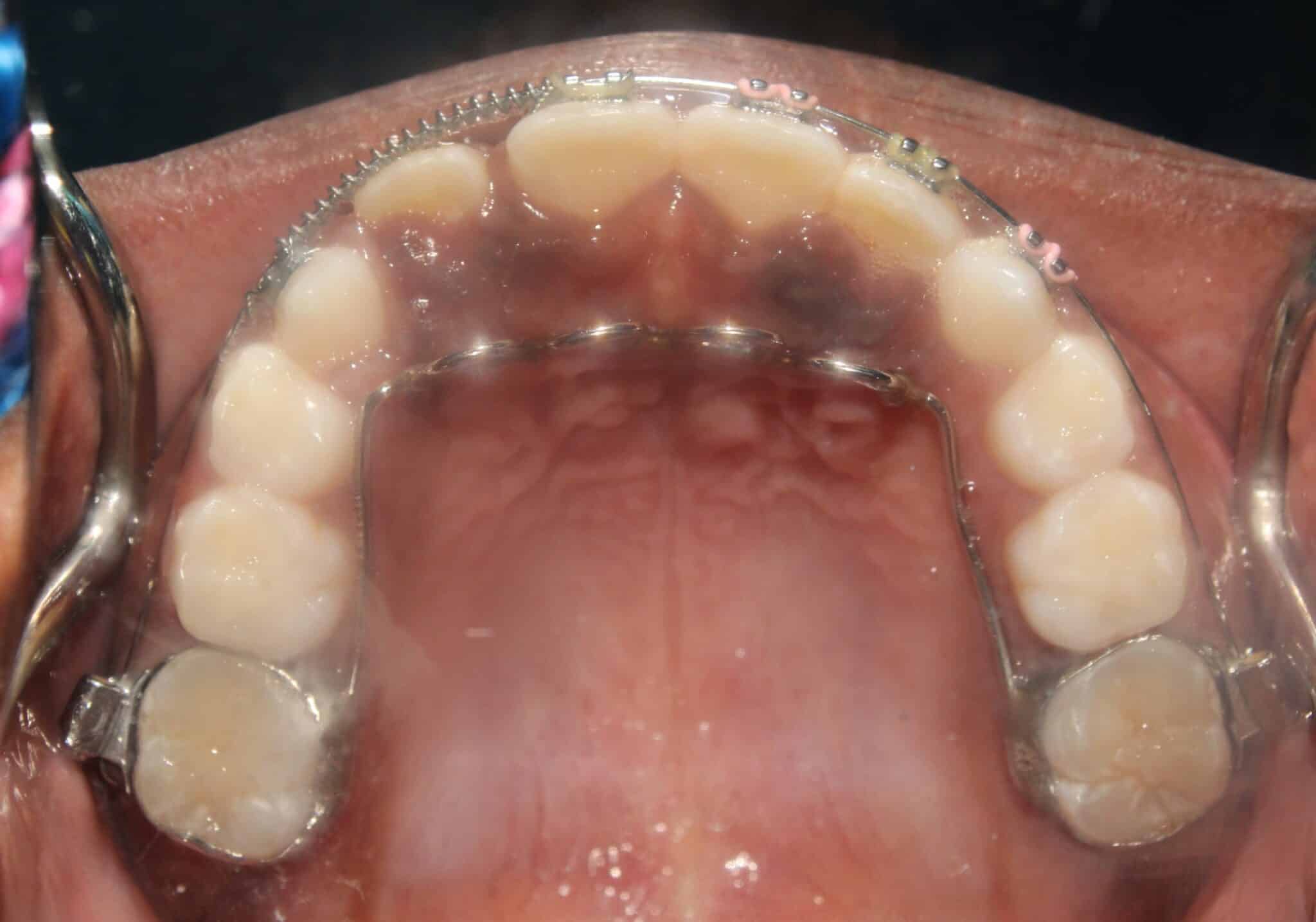 Understanding Open Bite in Orthodontics: Causes and Treatments