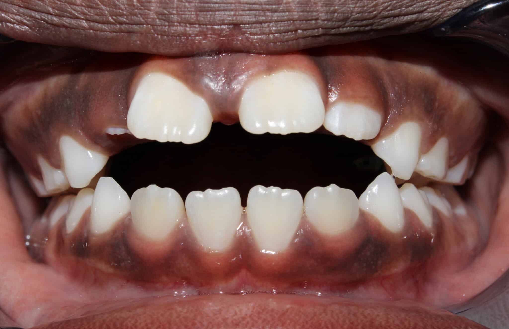 Understanding Open Bite in Orthodontics: Causes and Treatments